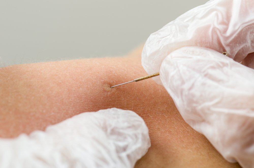 Three Benefits of Dry Needling: A Minimally Invasive Path to Pain ...